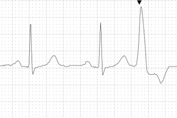 Heart conditions | Skipped heart beats | Dr Oliver Segal